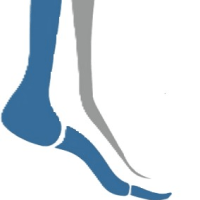 Posterior Tibial Tendon Dysfunction (PTTD) – Orthopedic Foot and Ankle ...